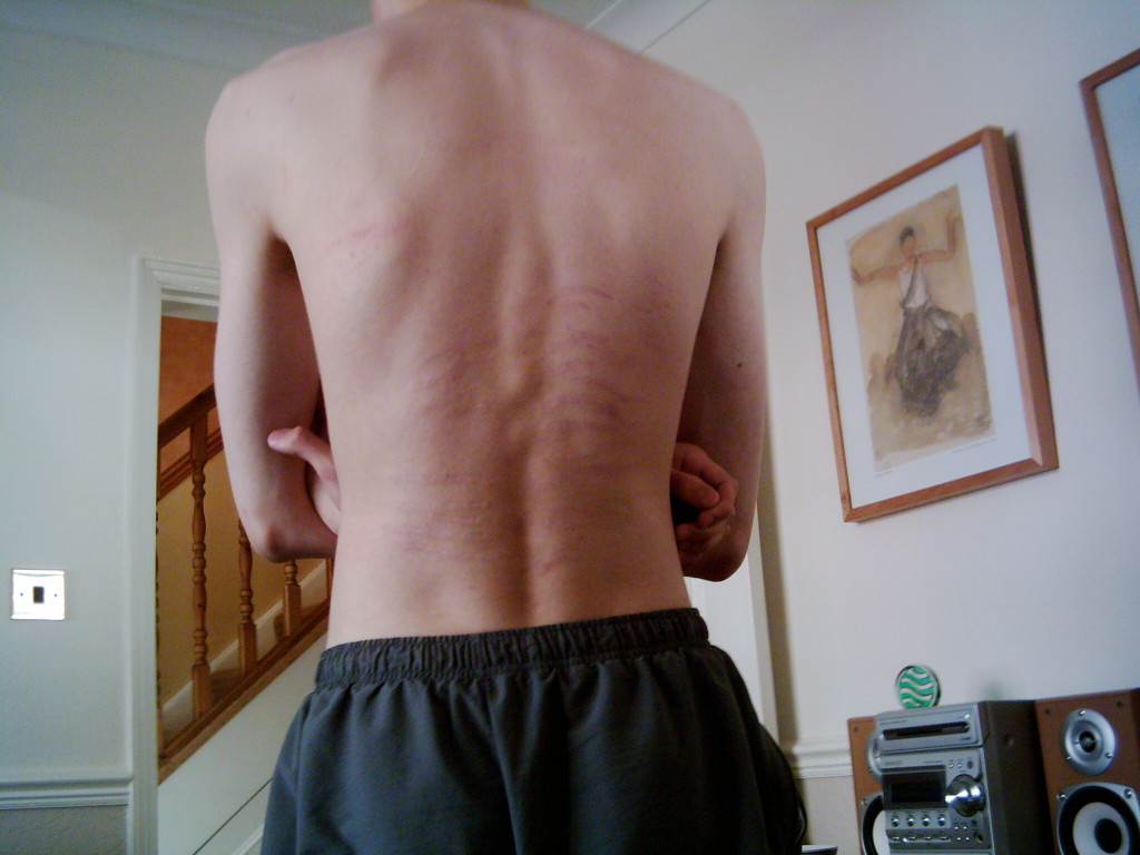 Stretchmarks From Growing - General Discussion - Neowin