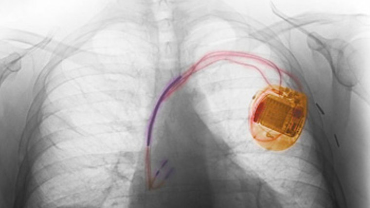 Over 8,000 bugs found in pacemaker codes, leaving them vulnerable to ...